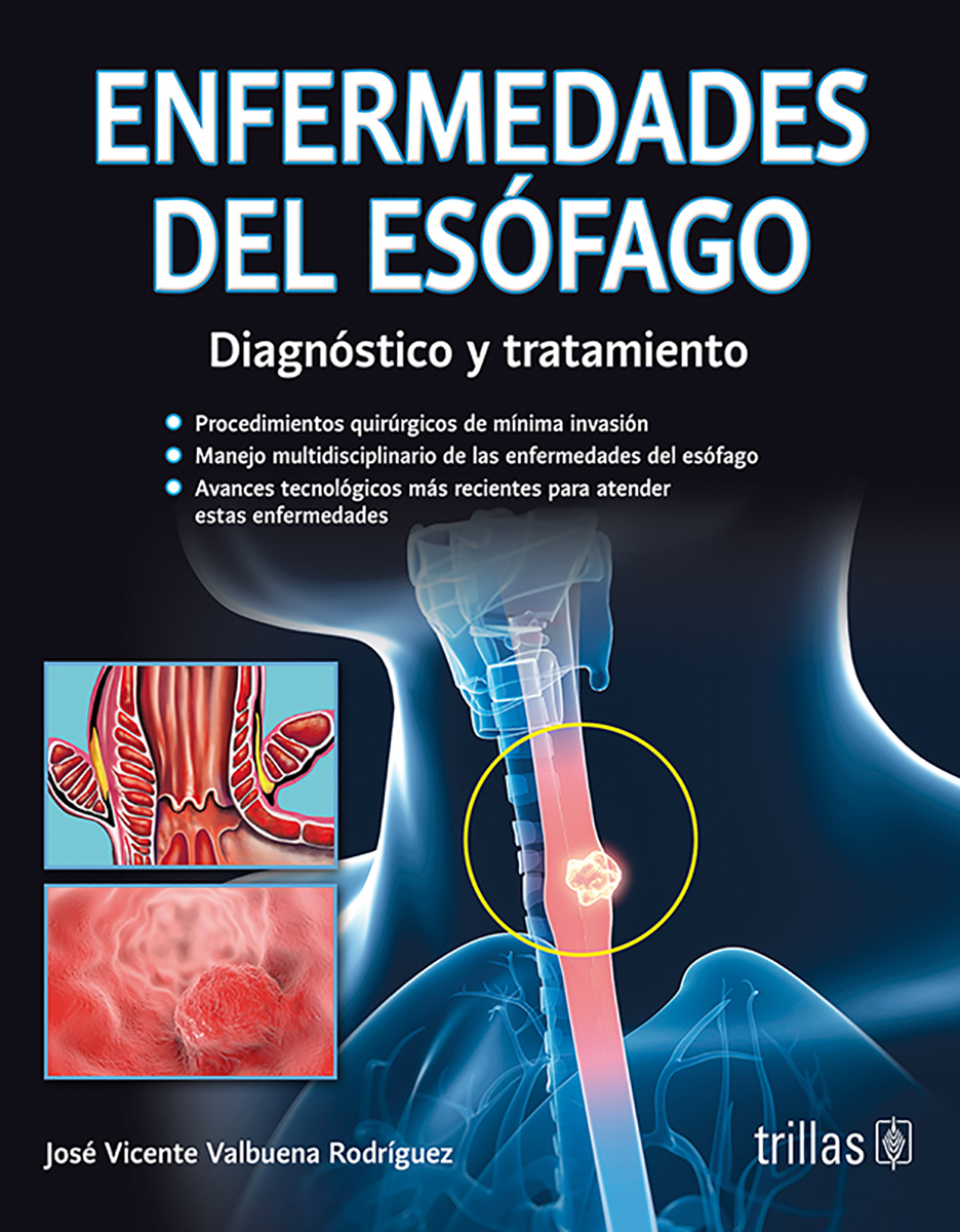Enfermedades del esófago